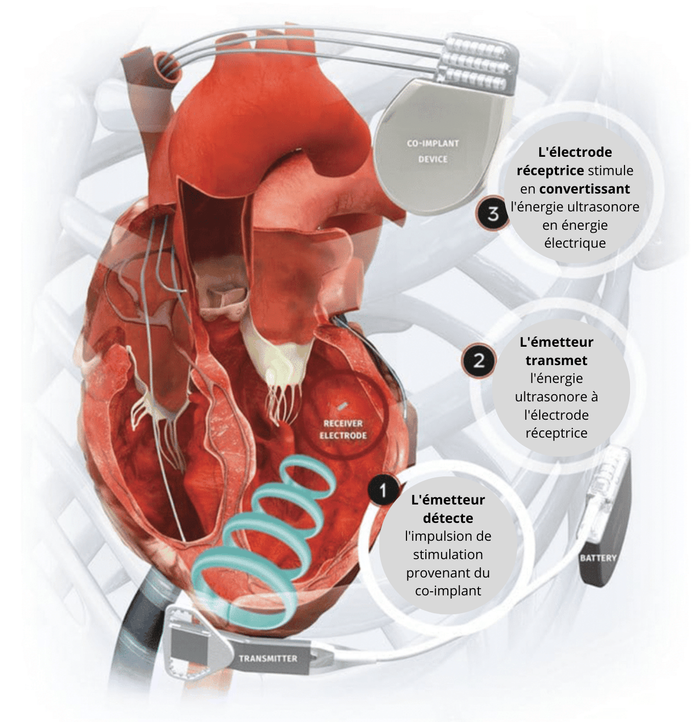 IDS209 - Évolution du parcours patient insuffisant cardiaque grâce aux ...